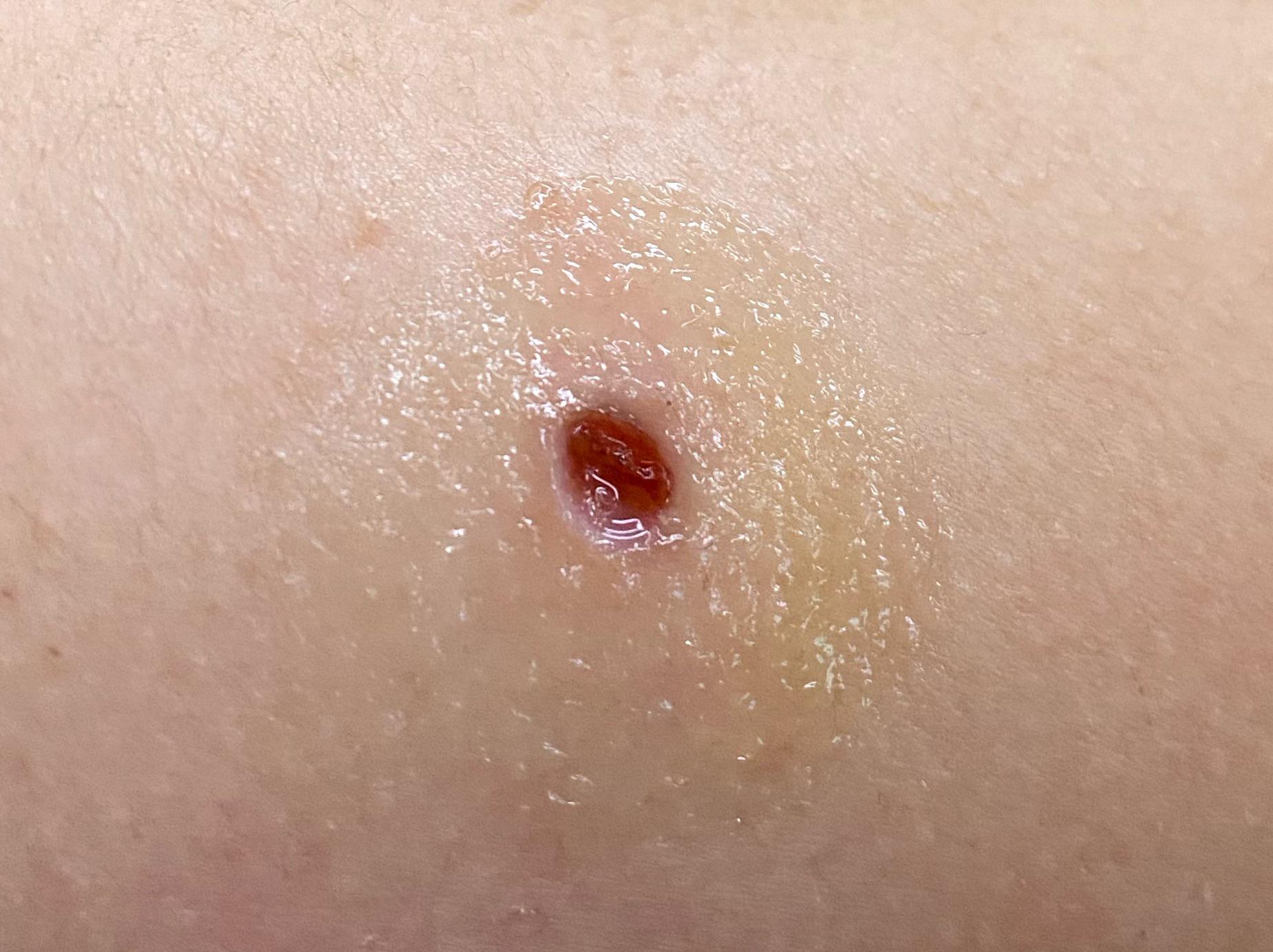 Skin Biopsy Butwal Skin Clinic